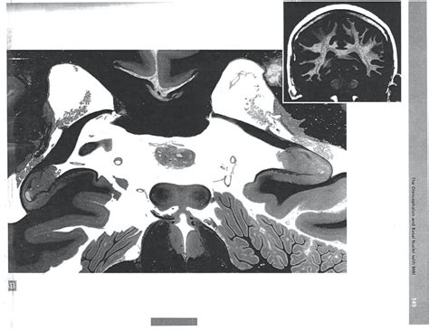 6 31 Brain Slice Diagram Quizlet