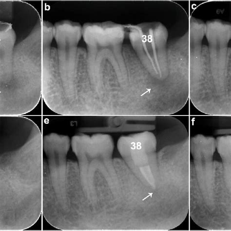 A Preoperative Intraoral Images Showing Complete Dislocation Of Tooth