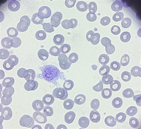 Atypical Lymphs Rmedlabprofessionals