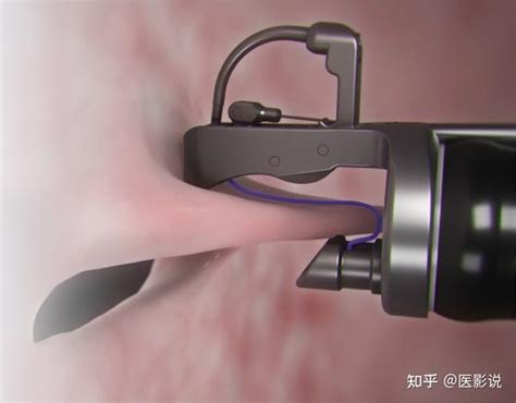 615亿！波士顿科学加码内镜市场，收购apollo进入减肥领域 知乎