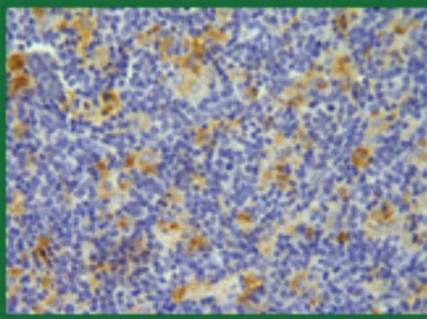 Dlbcl With Reactive Appearing Histocytes In The Background Ac ×200