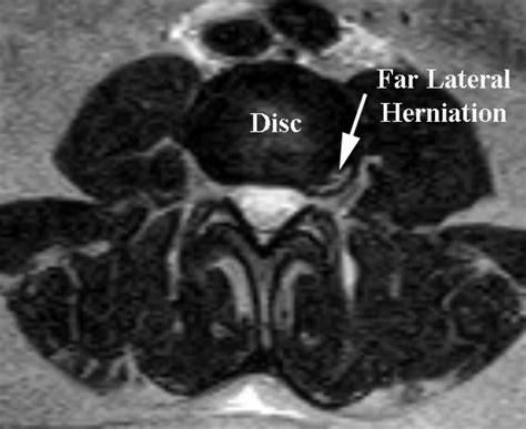 Disc Herniations Drwolgin