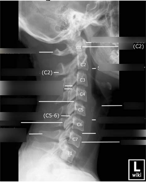 Cervical Grandy Xray Labeled Diagram Quizlet