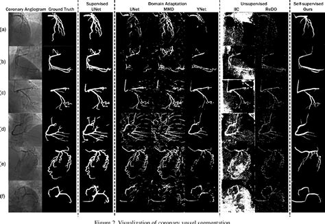 figure 1 from self supervised vessel segmentation via adversarial