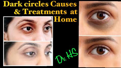 Dark Circlescauses And Treatments Drhsdark Circles Treatment At Home