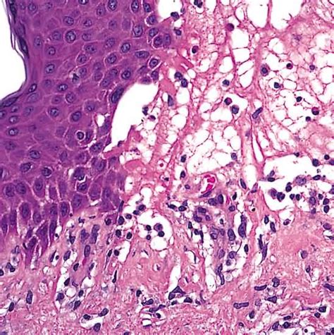 Bullous Pemphigoid Amer