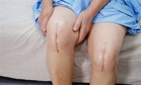 Deadlift After Knee Replacement A Journey Of Strength And Resilience