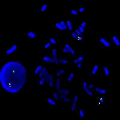 Acute Myelogenous Leukemia Aml Fish Panel Test In Delhi Ncr India Gdic