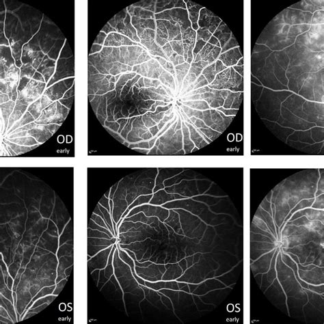 Fundus Fluorescein Angiography Showed Multiple Microaneurysms With
