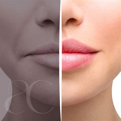 Lip Reduction Surgery Op Dr Abdullah Çalık