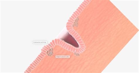 Premium Photo Endometrial Cancer Is A Type Of Cancer That Arises From