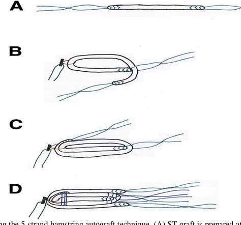 Figure 1 From Short Term Functional Outcomes In Five Strand Hamstring Graft For Anterior