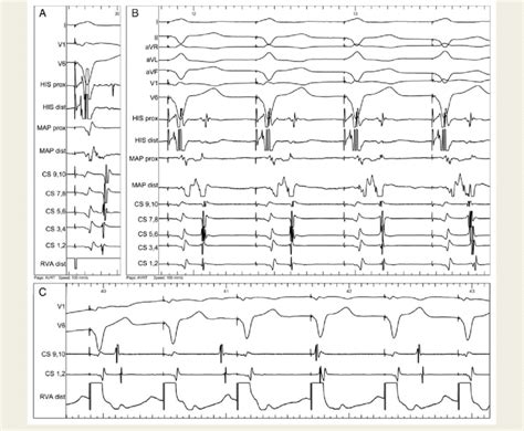A Activation Sequence During Right Ventricular Pacing Short