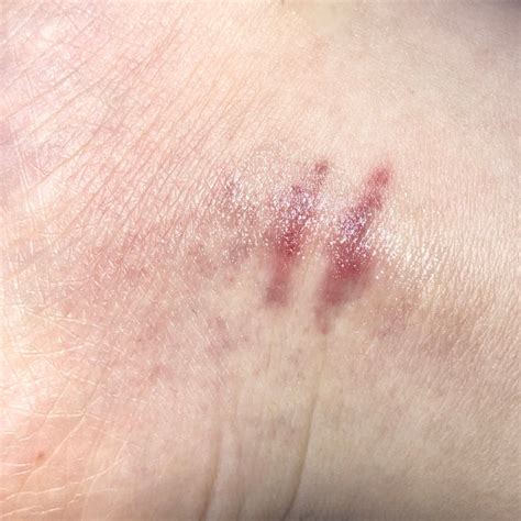 모기 물린 건가요 지식in