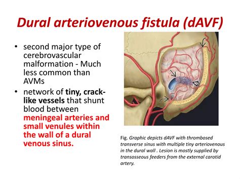 Intracranial Vascular Malformations Pptx