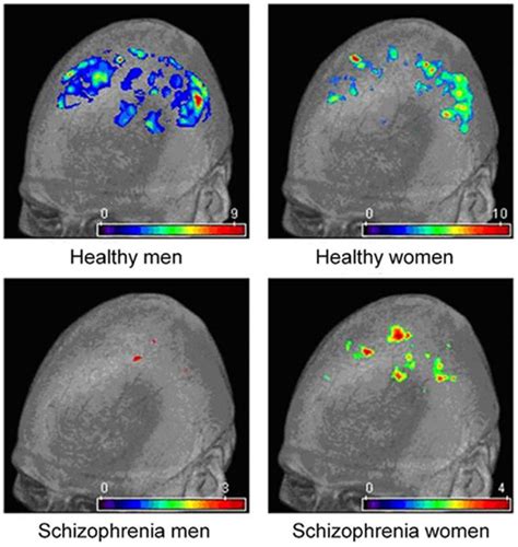 Voxel Based Morphometry Vbm Analysis Of Parietal Gray Matter Densities Download Scientific