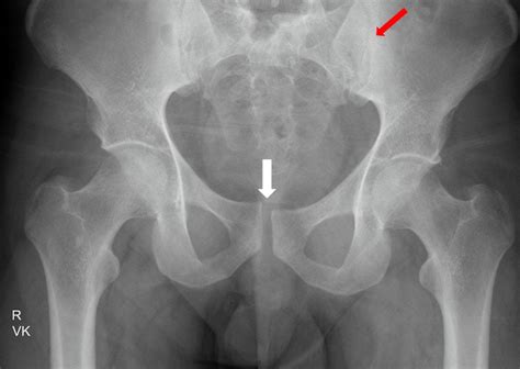 Pelvic Fracture X Ray