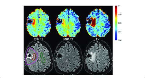 Flair Increase Pattern After Temporary T2 Decrease In Patient 2 The