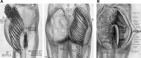 Massive Aneurysm In A Persistent Sciatic Artery Annals Of Vascular