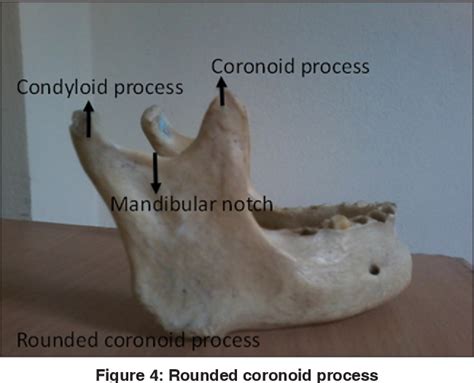 Condyloid Process Of Mandible