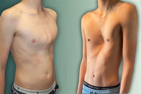 Differences Between Pectus Excavatum And Pectus Carinatum