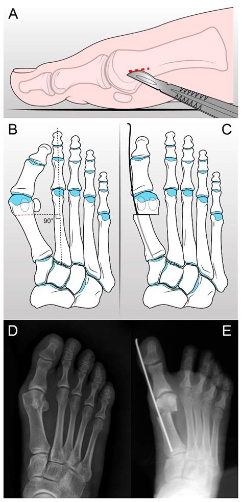 Distal Metatarsal Osteotomy For Hallux Varus Following Surgery For The