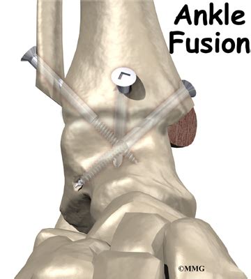 Fused Ankle Bones