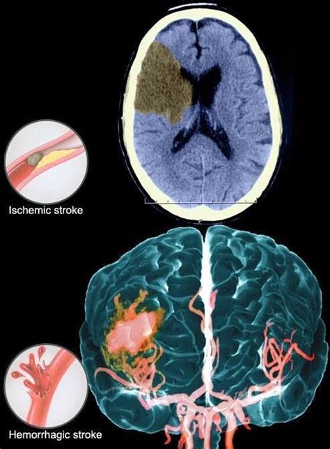 Visual Difference Between Ischemic And Hemorrhagic Strokes Anatomy And