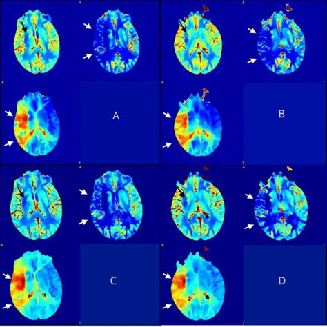 A B Cnn Outputs Maps From A Validation Set Cbv Cbf And Ttp C