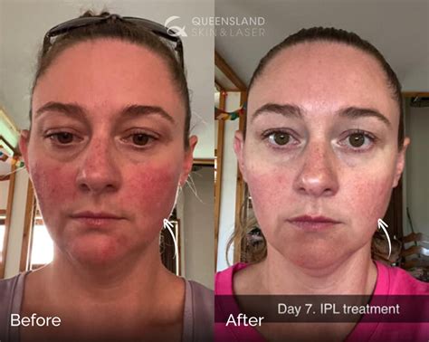 Rosacea Before And After Pictures