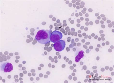 Multiple Myeloma Learnhaem Haematology Made Simple