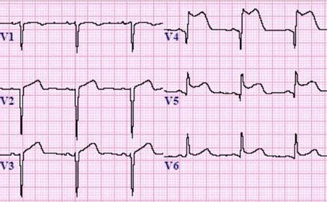 Gen Med 2 Unit 1 Ekg With Pictures Katie Flashcards Quizlet