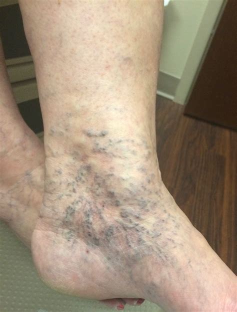 Chronic Venous Disease Of The Lower Extremities A State Of The Art