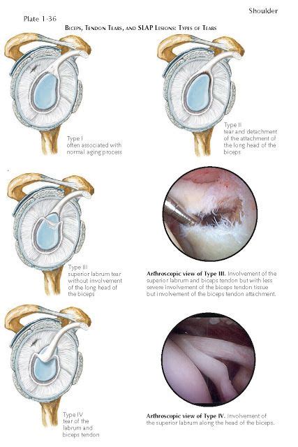 Biceps Tendon Tears And Slap Lesions Artofit