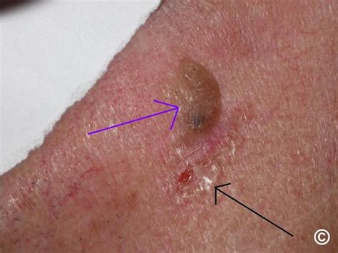 Seborrhoeic Keratosis