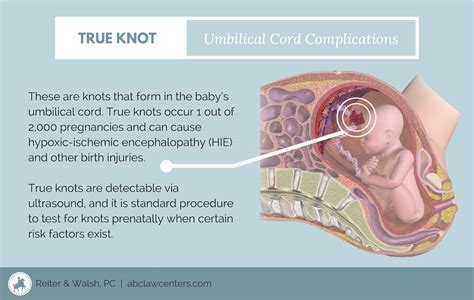 True Knot In Umbilical Cord True Knot Umbilical Cord Amniotic Fluid