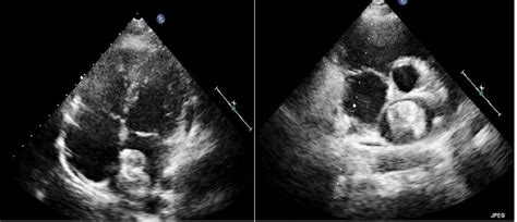 Echo Showing The Dislodged Device Into Left Atrium Download