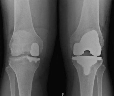 Robotic Mako Total And Partial Knee Replacement Dr Buechel And Patient