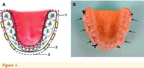 Figure 1 From In Situ Chlorhexidine Substantivity On Saliva And Plaque