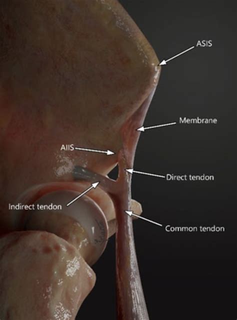 Open Access Understanding The Rectus Femoris Anatomy Diagnosis