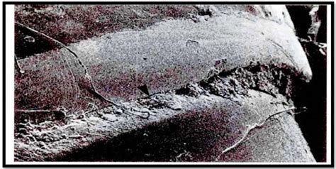 After Cementation Luting Material Prevents Approximation Of The Crown