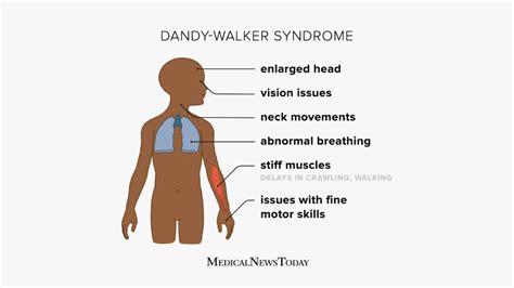 Down With Dandy Walker Syndrome Evidence Of Disrupted Rhombic Lip