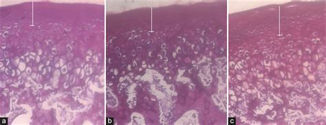 Genetic Expression Of Vascular Endothelial Growth Factor Decorin And