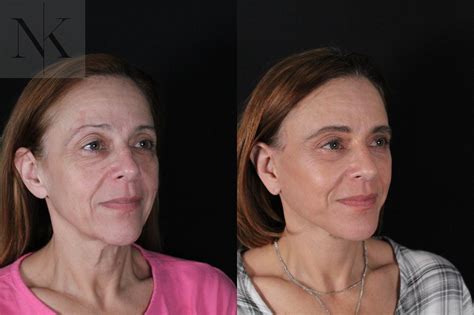 Deep Plane Facelift Before And After Pictures Case 219 Wethersfield