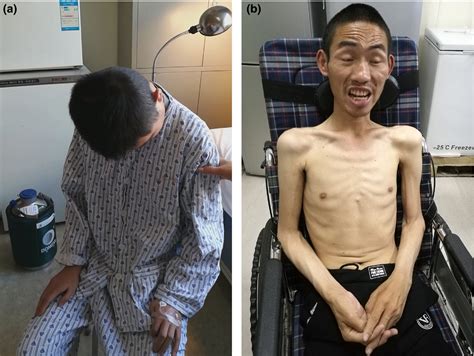 Alsfus Pathology Revisited Singleton Fus Mutations And Als Mutations