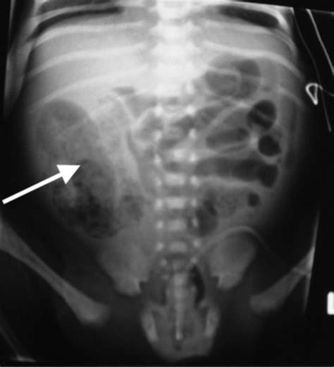 Necrotizing Enterocolitis X Ray
