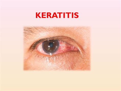 Keratitis Also Known As Corneal Ulcer Is An Inflammation Of The Cornea The Clear Dome On The