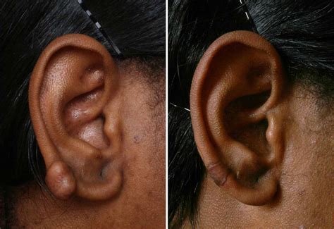 Keloid Treatment With Cryoshape Is Now Available In Philadelphia And On