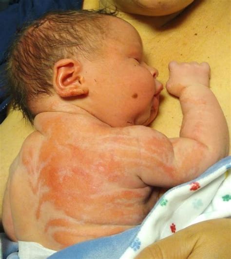 Epidermal Nevus Newborn Racgp Birthmarks Identification And