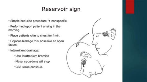 Csf Rhinorrhea Overview